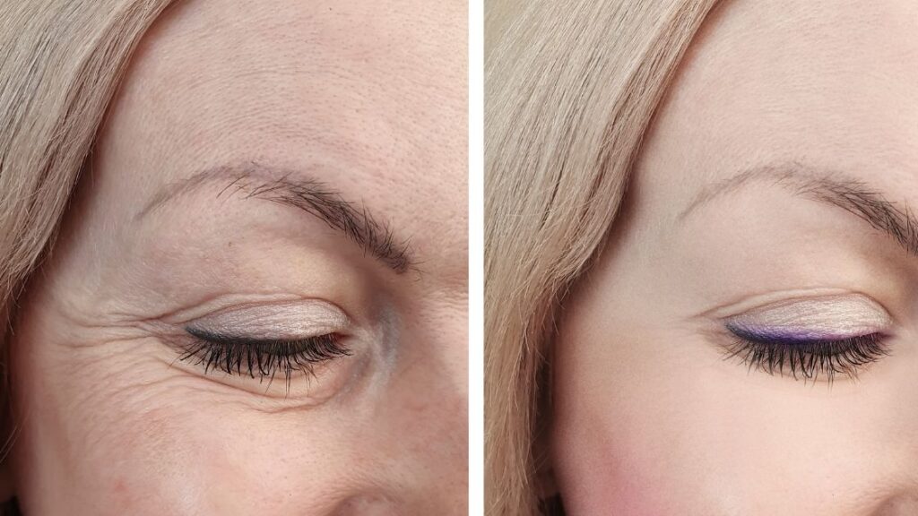 11 Ways Dermal Filler Treatment Can Improve Your Appearance