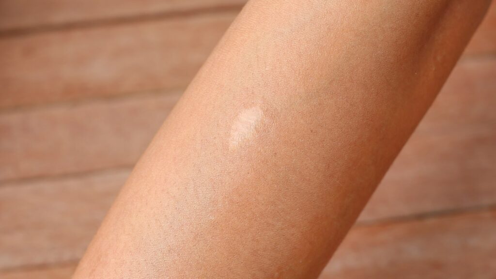 Everything you need to know about Micropigmentation treatment - Dr.Renu ...