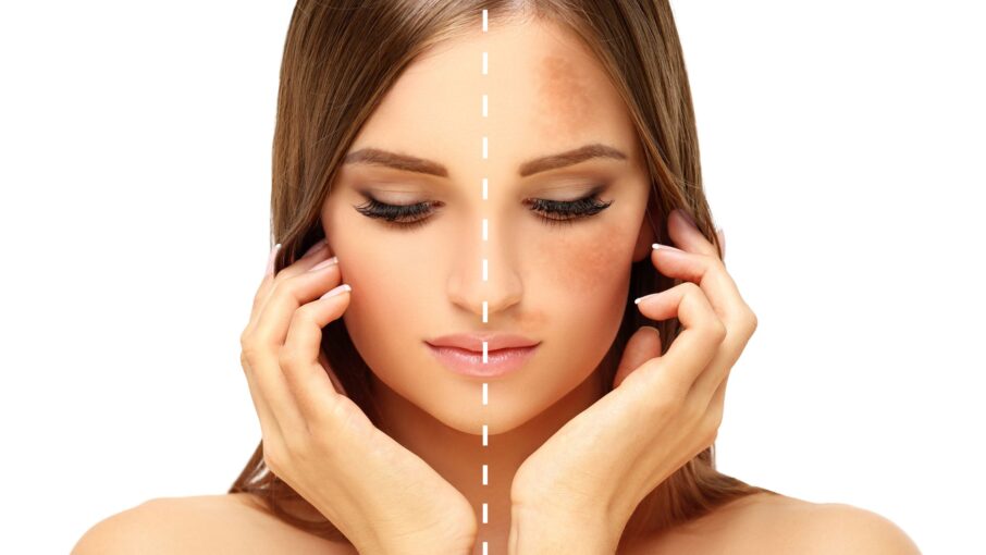 How to Remove Pigmentation From Face Permanently at Home? |Dr. Renu