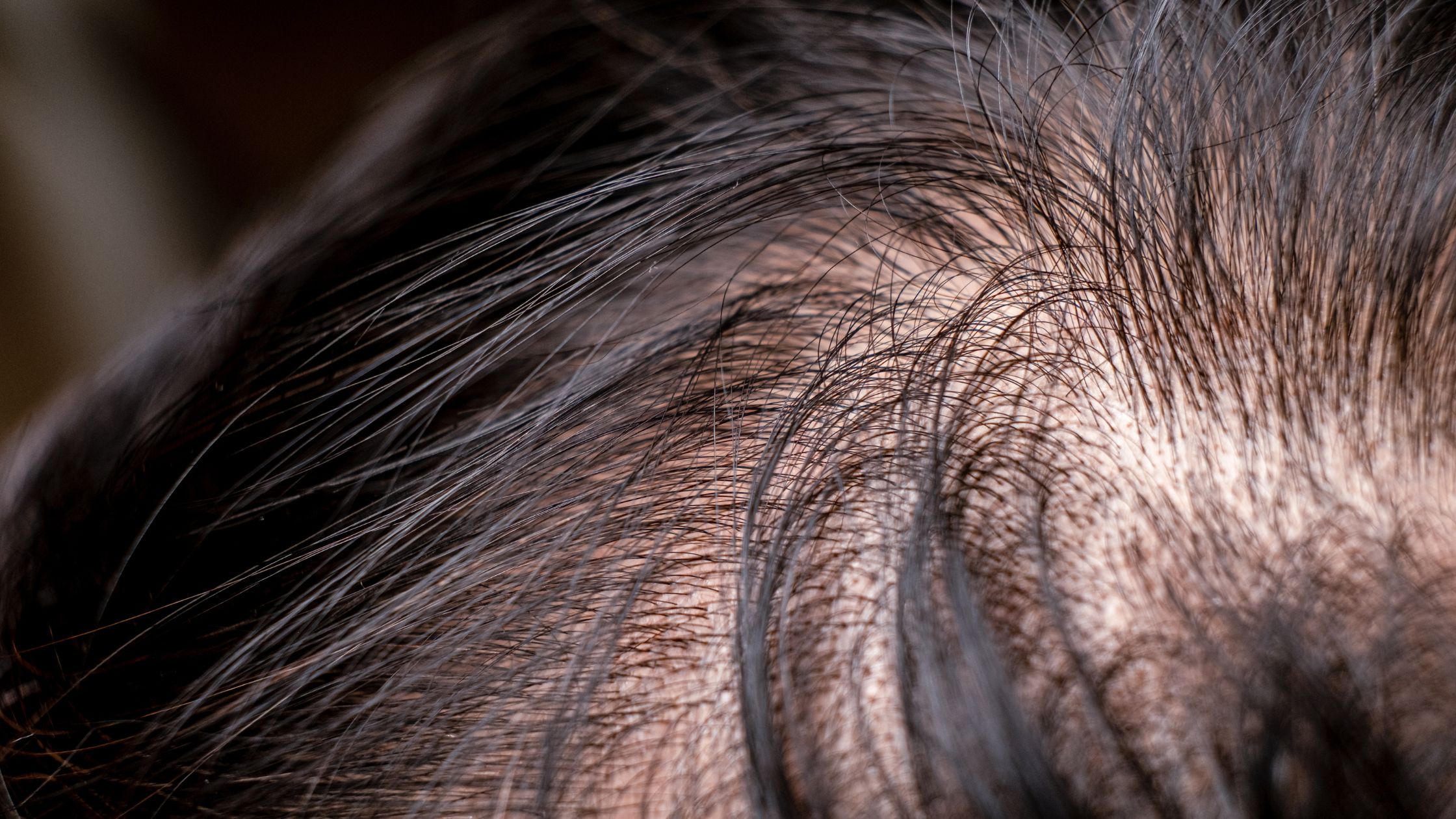 Teenage Balding Treatments In Bangalore - Dr.Renu | Dermatologist