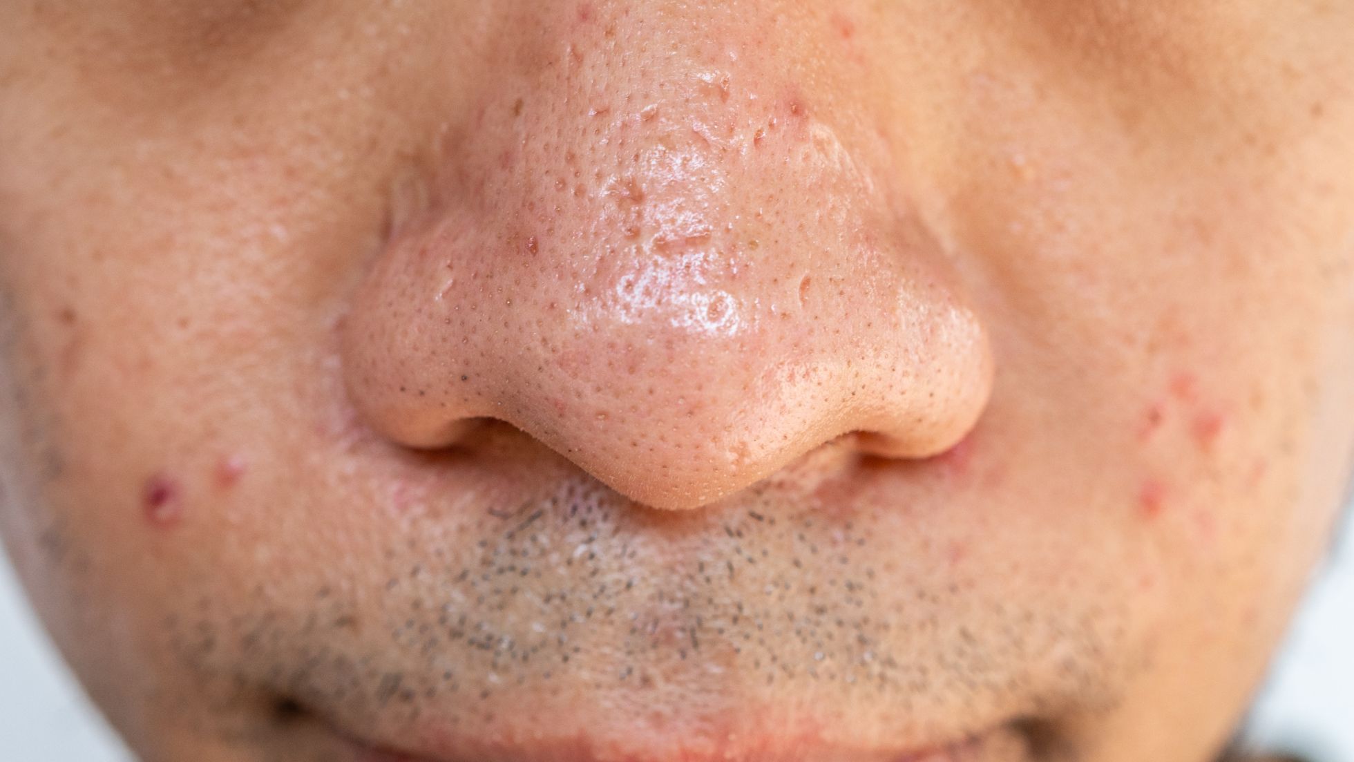 A Guide to Unclogging Pores - Dr.Renu | Dermatologist